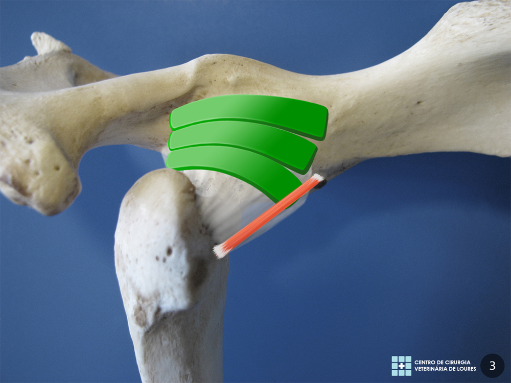 modified DARthroplasty | DARthroplasty